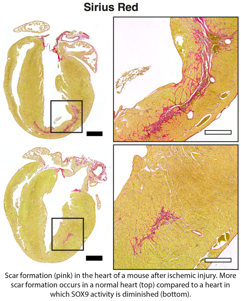 SOX9 gene involved in scar formation after myocardial infarction ...