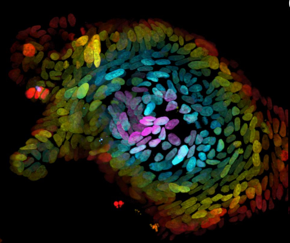 Chromosomal instability in colorectal cancer - Hubrecht Institute