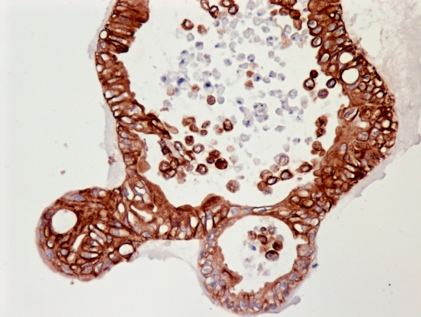 Culturing ovarian cancer organoids - Hubrecht Institute Culturing ovarian cancer organoids - Hubrecht Institute