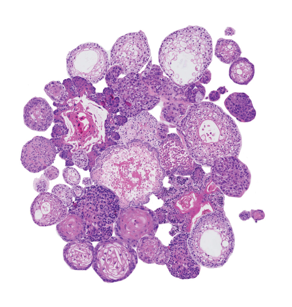 Testing therapies on mini-tumors of head and neck cancer - Hubrecht ...