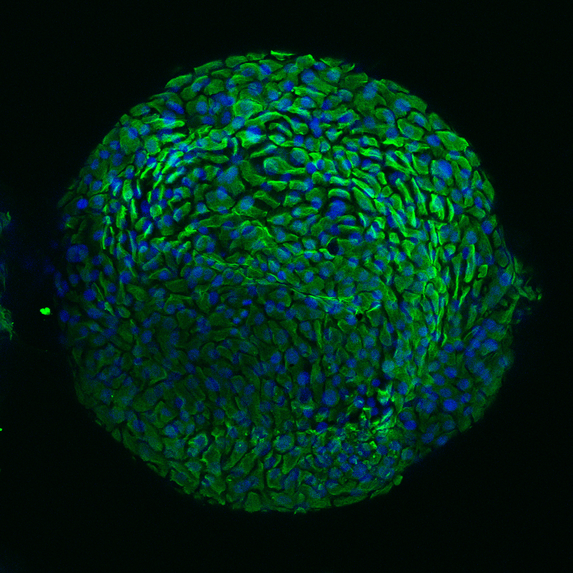 First Patient Derived Organoid Model For Cervical Cancer