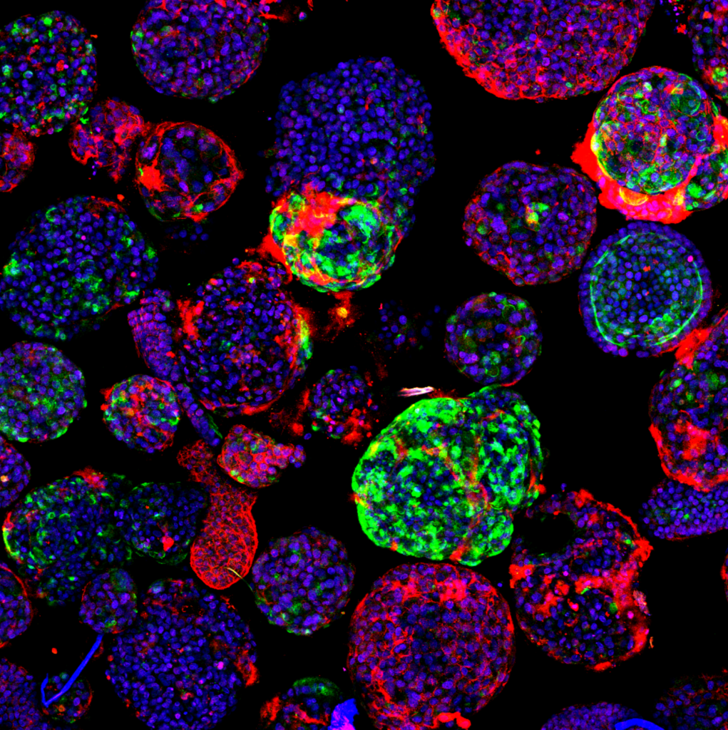 New insights into liver cancer using organoids - Hubrecht Institute