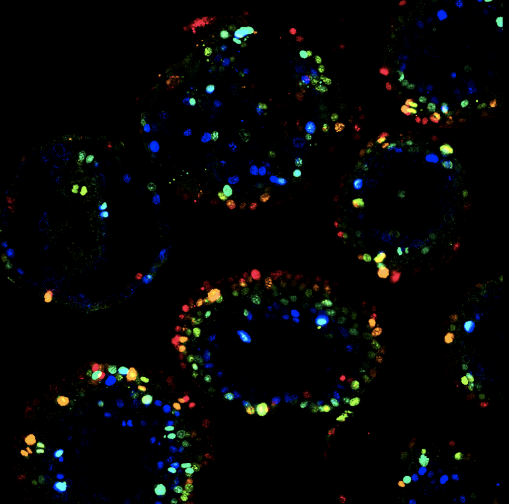 New insights into liver cancer using organoids - Hubrecht Institute