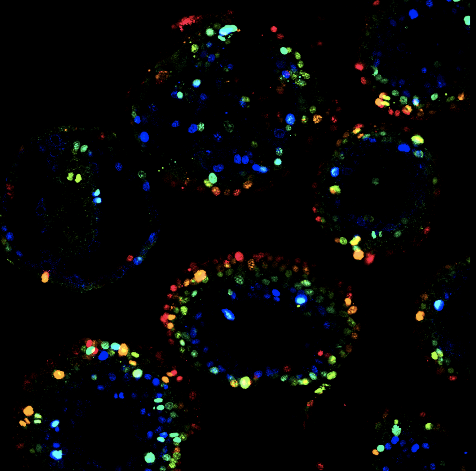 New insights into liver cancer using organoids - Hubrecht Institute